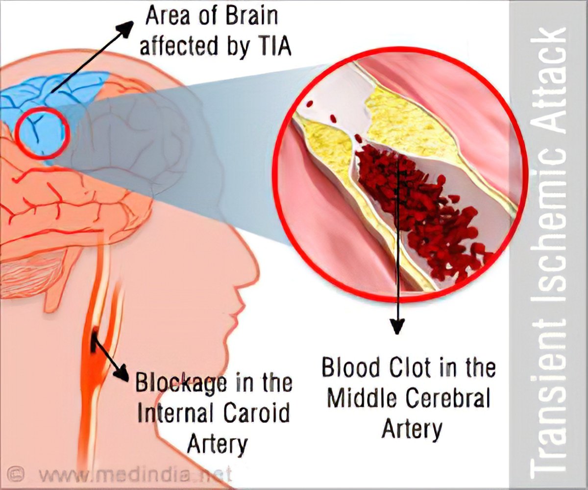 Transient Ischemic Attack Risk Factors Symptoms Diagnosis 58 OFF