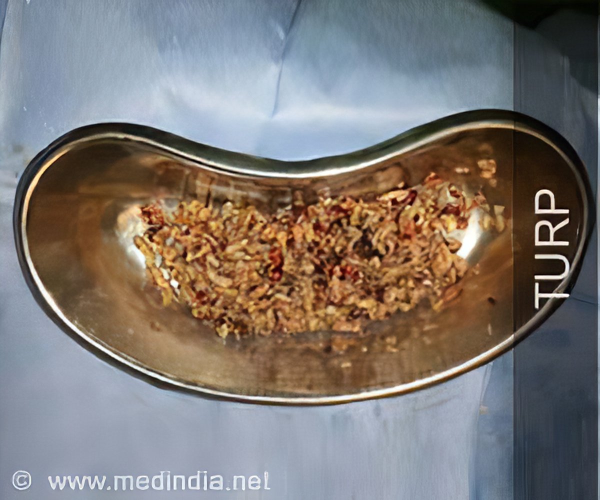 Transurethral Resection Of Prostate TURP For Prostate Enlargement