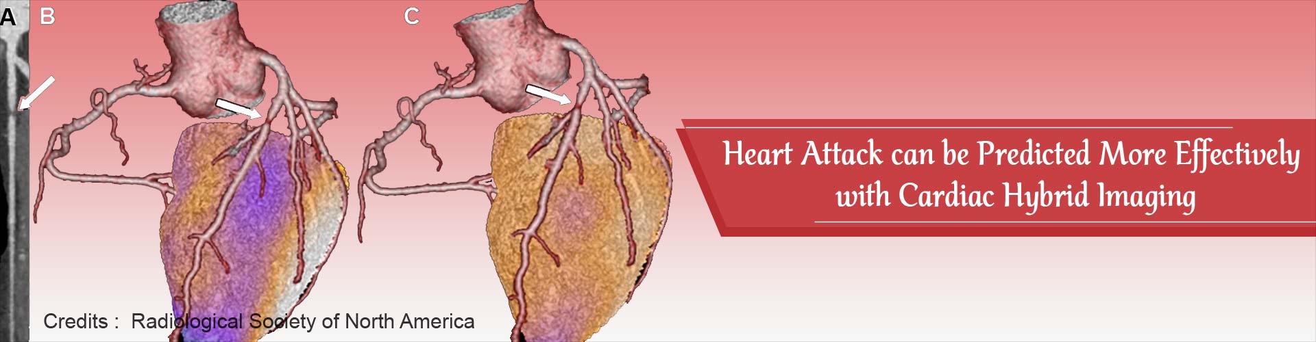Cardiac Hybrid Imaging Can Predict Heart Attack Effectively