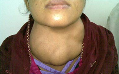 Disease caused by deficiency of iodine store
