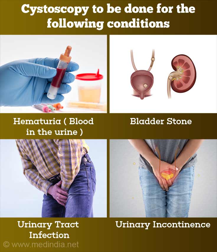 Cystoscopy Purpose Preparation Procedure Complications